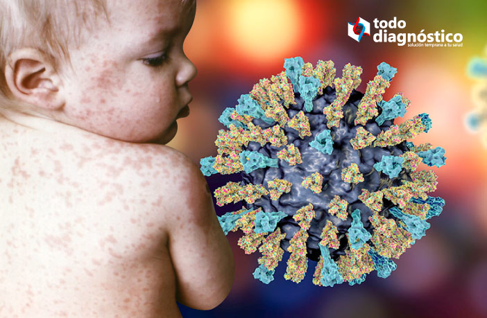 Vigilancia epidemiológica del sarampión - Todo Diagnóstico
