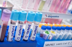 Utilidad del dímero D en el pronóstico de pacientes con Covid-19